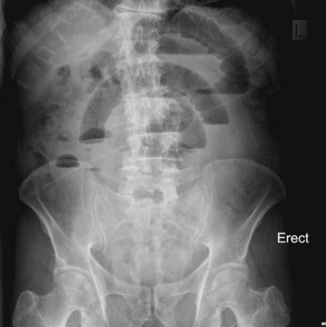 Small Bowel Obstruction Anesthesia Key
