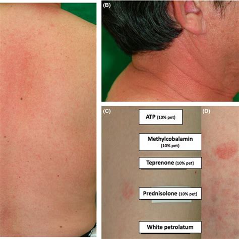 Clinical Appearance And Patch Test Findings A B Cutaneous Download Scientific Diagram