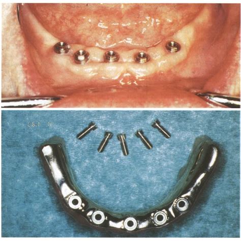 Design Of Fixed Prosthesis To Be Connected Directly Onto Implants
