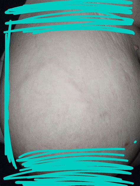 Non Lactational Mastitis Not Responding To Antibiotics R Askdocs