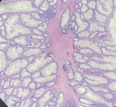 Polyp Classification Live Case See Comments For Details Rpathology