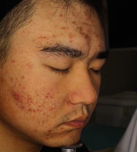 Acne Object Detection Model V Pm By Andrei Dore