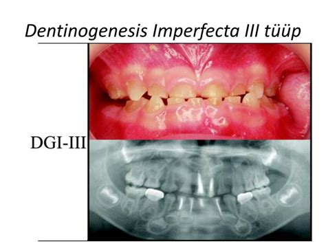 Ppt Hammaste Morfoloogilised Muutused Dentinogenesis Imperfecta Puhul