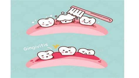 Gingivitis Main Pptx