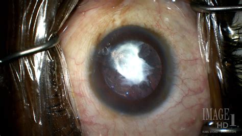 Moran Core Spontaneous Cataract Absorption