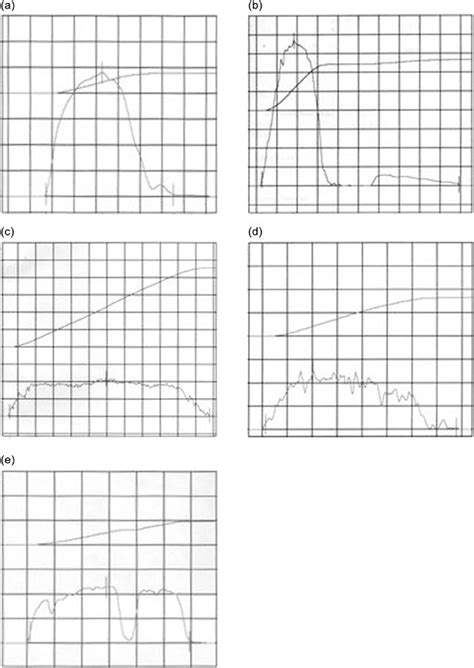 Five Urinary Flow Patterns Shown In The Uroflowmetry The Download