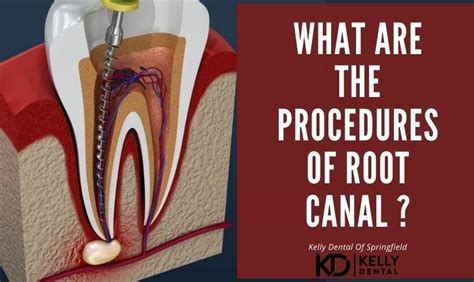 The Procedure Of Root Canal Treatment