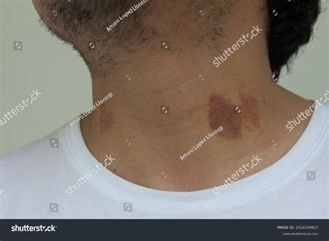 Fotografías De Una Persona Con Hematomas Foto De Stock 2524259927