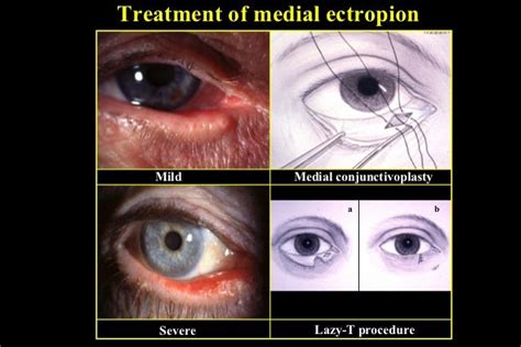 Ectropion And Entropion