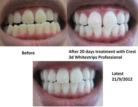 Crest Teeth Whitening Strips Before And After