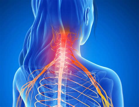 Can Sciatica Cause Neck Pain Exploring The Surprising Connection