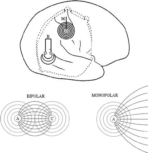 Bipolar Vs Monopolar Stimulation At Joanne Magana Blog