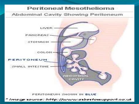 Ascites Mu1ppt Case Presentation Of Ascites Ppt