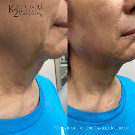 Pdo Threads Lift At K2 Restorative Medicine In Birmingham Al