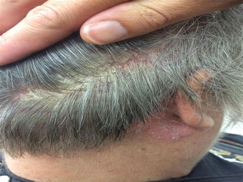 Scalp Conditions
