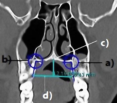 Assessment Of The Relationship Between Palatum Durum And Maxillary Bone
