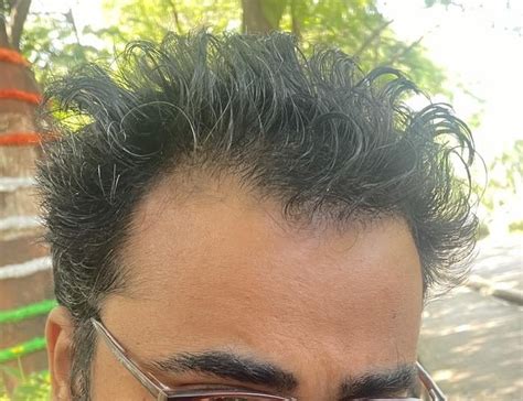 What Is This Stage In The Balding Process R Malegrooming