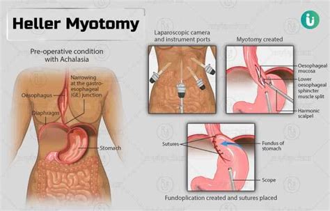 Heller Myotomy Procedure Purpose Results Cost Price