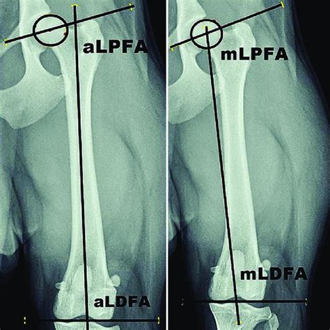 Measurement Of The Anatomical Lateral Proximal And Distal Femoral