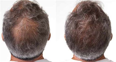 Does Nioxin Work For Hair Loss Growth And Thinning Hairmag