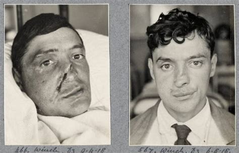 Harold Gillies The Surgeon Who Rebuilt The Faces Of Ww1 Veterans