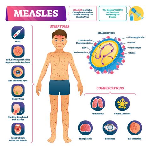 380 Measles Stock Illustrations Royalty Free Vector Graphics And Clip