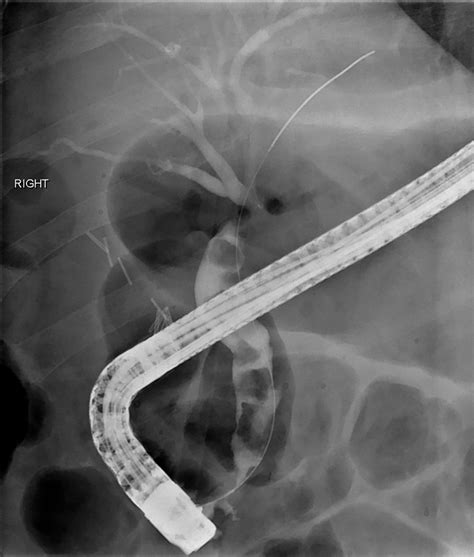 Ercp The Good Bad And Ugly Medical Forum