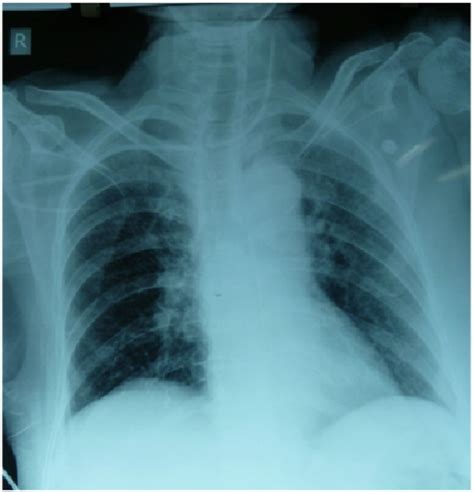 Chest X Ray Showing Malpositioned Central Venous Catheter Present In Download Scientific