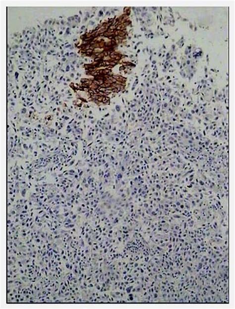 Example Of Immunohistochemical Her2 Staining Of Primary Cervical