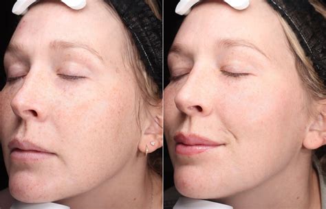 Hero Bbl Belle Marin Aesthetic Medicine