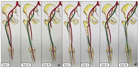 Different Manifestations Of Persistent Sciatic Artery And Possible