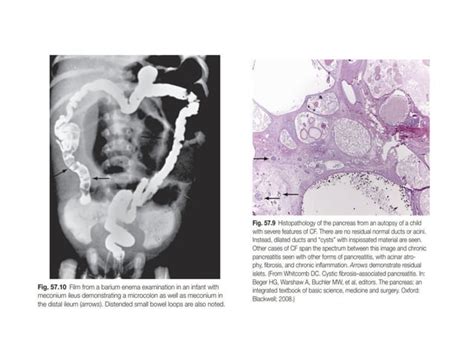 Hereditary And Familial Pancreatitispptx
