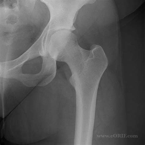 Normal Hip Joint Anatomy Xray Ebfity
