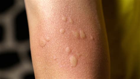 6 Surprising Triggers Of Hives You Might Not Expect