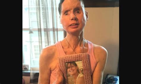 Where Is Charla Nash Now Her Story Life Before And After Chimp Travis