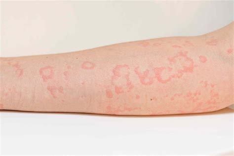 Pictures Of Hives Urticaria To Help Identify A Skin Rash