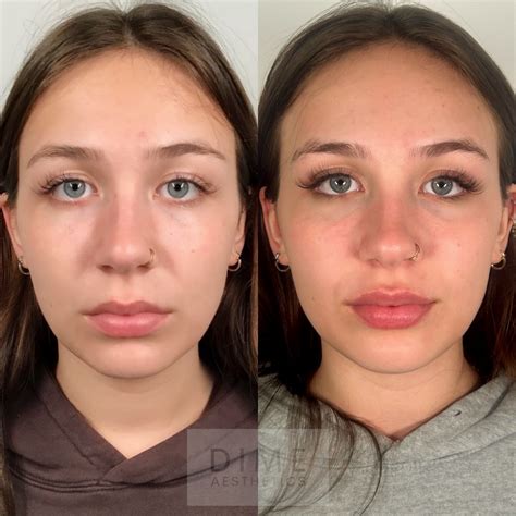 Chatt And Cleveland Tn Botox And Filler Weight Loss Skincare