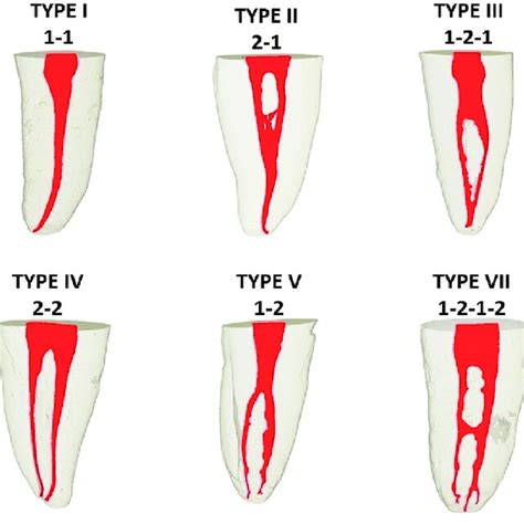 Vertuccis Classification By Micro Ct Observed In Mandibular Premolars Download Scientific