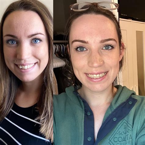 Adult Braces Progress Rbraces