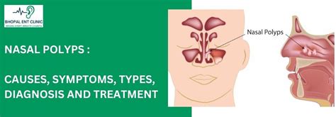 Nasal Polyps Causes Symptoms And Diagnosis