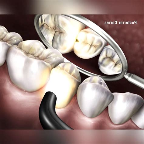 Durable Transillumination Caries Detector Sale Or Rent Near Me