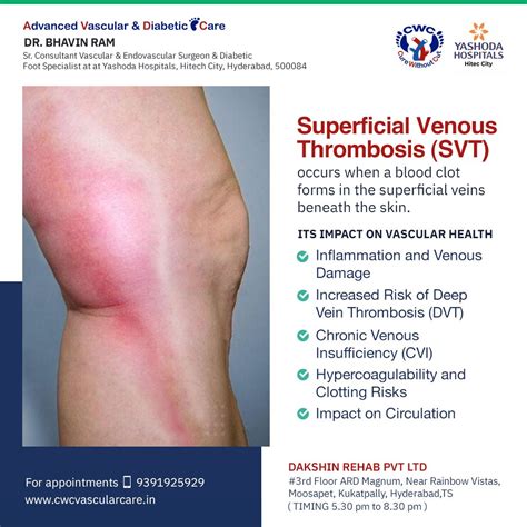 Superficialvenousthrombosis Svt Vascularhealth Deepveinthrombosis