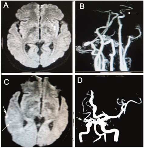 Diffusion Weighted Imaging Dwi And Vascular Imaging Of Acute