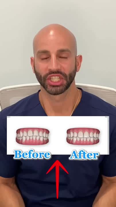 Video Jet Boutique Orthodontics On Linkedin Lower Teeth Overcrowding