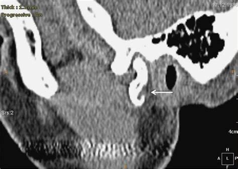 Sagittal Non Contrast Enhanced Ct View Showing Stafnes Bone Defect In Download Scientific