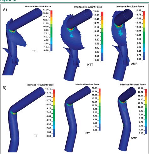 Figure 10 From The Hybrid Transtibial Technique For Femoral Tunnel