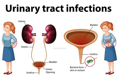 Urinary Tract Infection How To Treat At Home At Louise Costa Blog