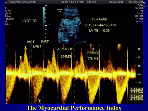 Fetal Echo Measurments Pptx