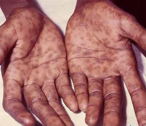 Syphilis Symptoms And Treatment Private Testing Center