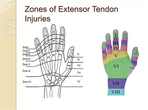 Hand Injuries And Their Managements Pptx